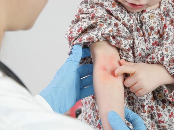 Psoriasis Treatment - Porter Premiere Dermatology and Surgery Center